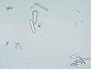 Types of Crystals Found In Human Urine and Their Clinical Significance ...