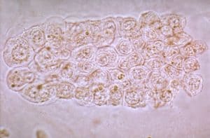 Types Of Casts Found In Urine And Their Clinical Significance ...