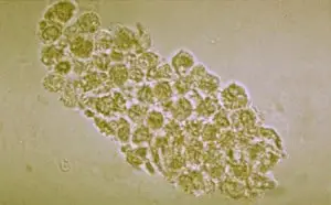 Types Of Casts Found In Urine And Their Clinical Significance ...