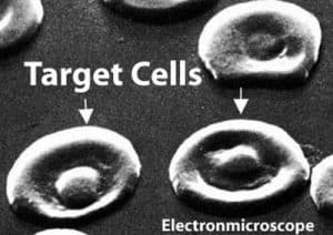Target Cells - Causes, Examples and Images - Laboratoryinfo.com