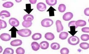 Target Cells - Causes, Examples and Images - Laboratoryinfo.com