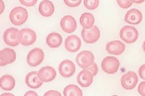 Target Cells - Causes, Examples and Images - Laboratoryinfo.com