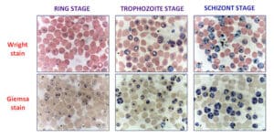 Wright's Stain - Procedure, Principle, Components, Uses and Blood smear ...